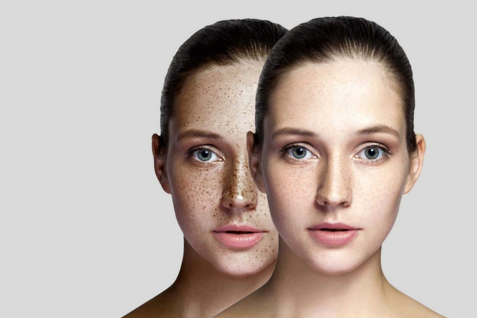 Skin Pigmentation - SkinSpaceUK