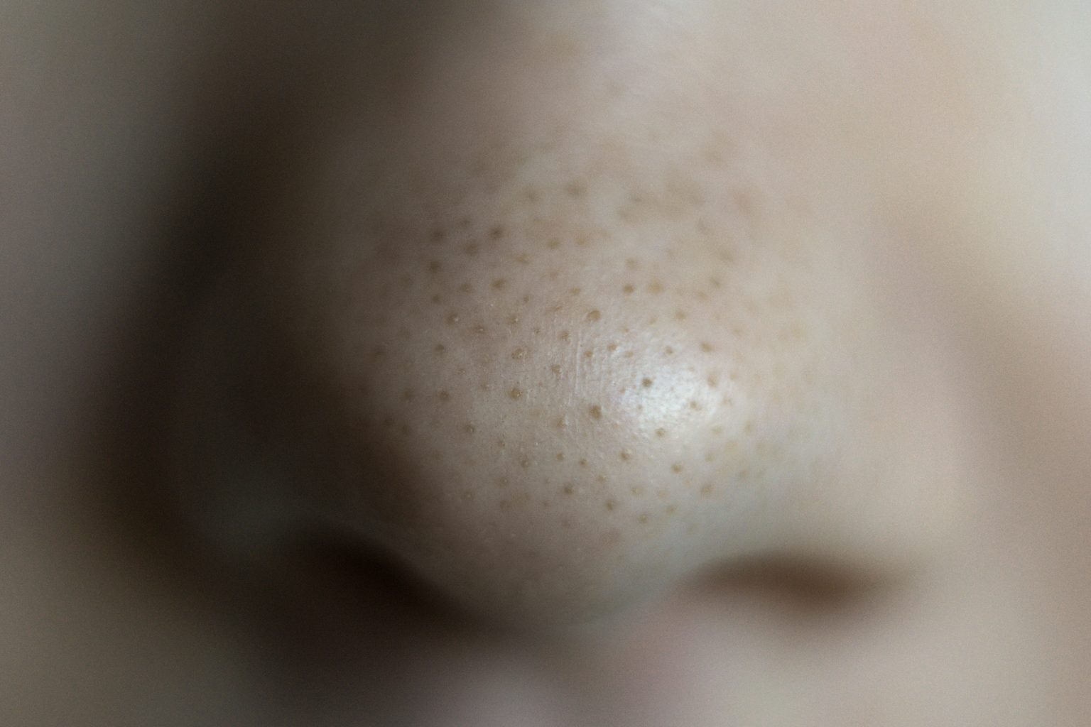 Congested Skin - SkinSpaceUK